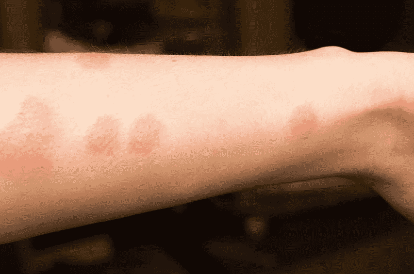 Disinfestazione Pulci - Servizi Professionali